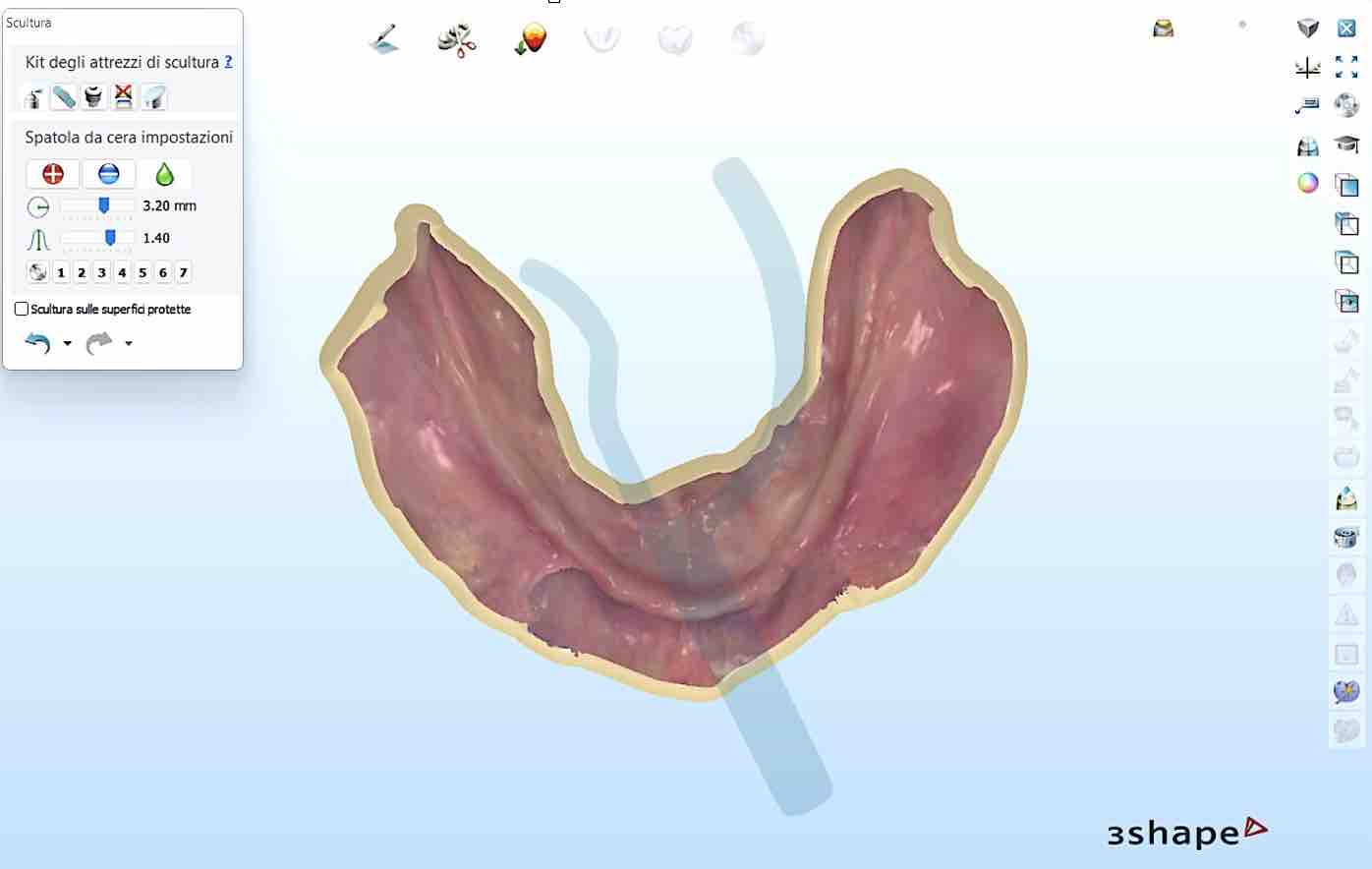 Why Edentulous Intraoral Scanning Fails | Causes and Solutions